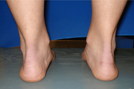 Treatment of an Unusual Foot Neuropathy in a College Aged Runner: A ...