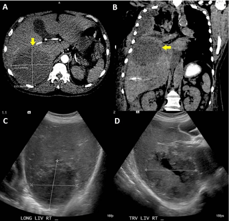 Amebic Liver Abscess Masquerading Like Pyogenic Hepatic Abscess: Get ...
