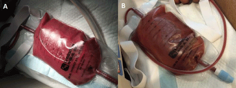 Anchovy Sauce Liver Abscess