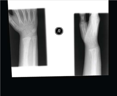 Does Distal Radius Reconstruction by Free Epiphyseal Transfer Lead to ...