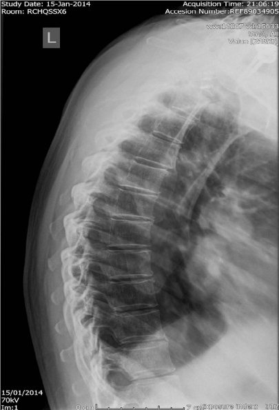 Multiple Contiguous Avulsion Fractures of Thoracic Spinous Processes: A ...