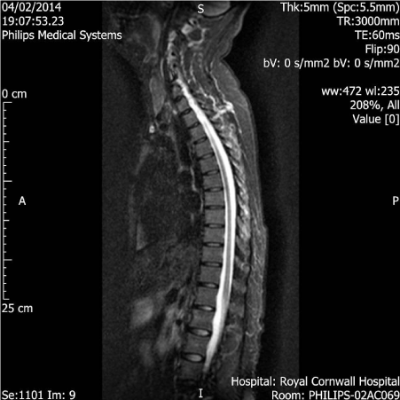 Multiple Contiguous Avulsion Fractures of Thoracic Spinous Processes: A ...
