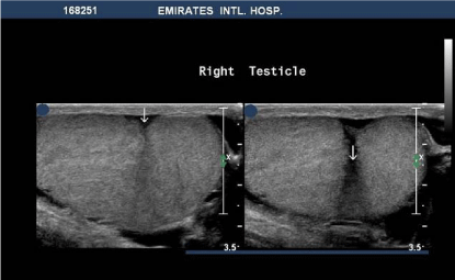 Lobulation of the Testicles: A Case Report