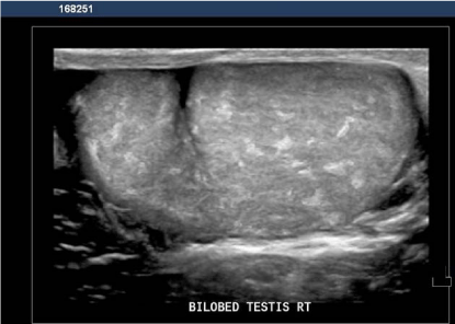 Lobulation of the Testicles: A Case Report