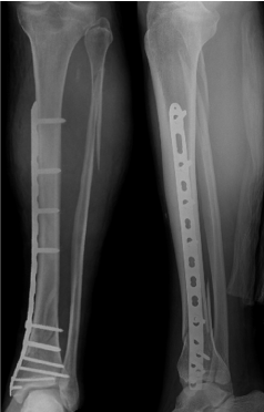 A Simple Technique for Less Invasive Treatment of an Acute Infection ...