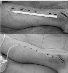 A Simple Technique for Less Invasive Treatment of an Acute Infection ...