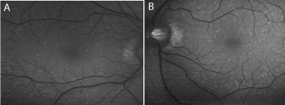 Fundus Albipunctatus: A Novel Mutation