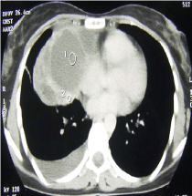 Adult Mediastinal Mesenteric Cyst: A Rare Mediastinal Tumor