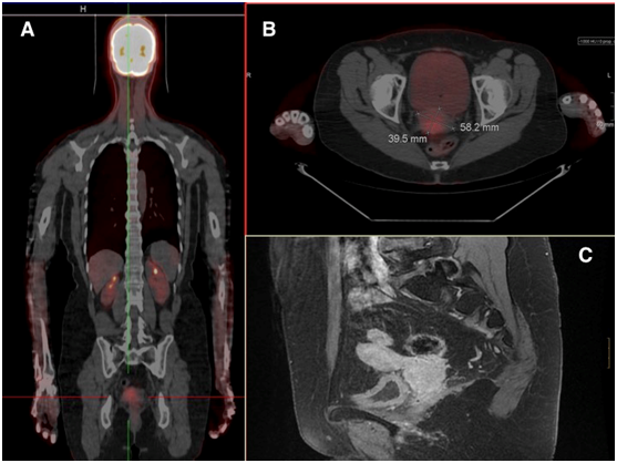 Laparoscopic-Assisted Vaginal Pelvic Exenteration and Reconstructive ...