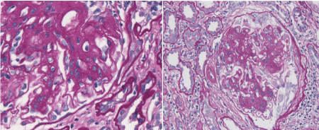 Focal Fibrocartilaginous Dysplasia (FFCD)