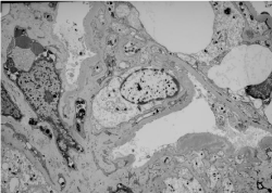 Focal Fibrocartilaginous Dysplasia (FFCD)
