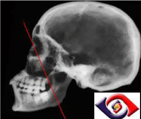 A Case of Nasal Squamous Cell Carcinoma with the Clinical Symptom of ...