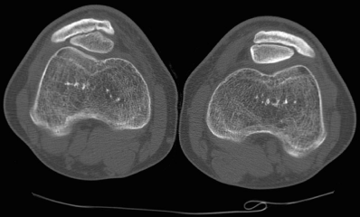 Bilateral Double-Layered Patella (DLP) with Suprapatellar Impingement