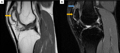 Bilateral Double-Layered Patella (DLP) with Suprapatellar Impingement
