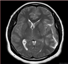 Dural Marginal Zone Lymphoma Presented as Brain Herniation: A Case Report