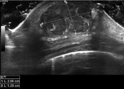 Neonatal Mastitis and Breast Abscess due to Meticilin Resistant ...