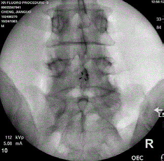 Interventional Management of Chronic Low Back Pain Associated with ...