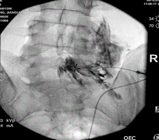 Interventional Management of Chronic Low Back Pain Associated with ...