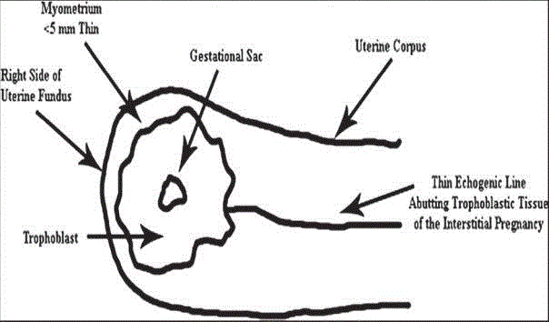 Interstitial Ectopic Pregnancy, Diagnosis and Management: A Case Report ...