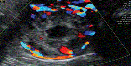 Interstitial Ectopic Pregnancy, Diagnosis and Management: A Case Report ...