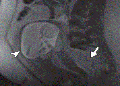 Interstitial Ectopic Pregnancy, Diagnosis and Management: A Case Report ...