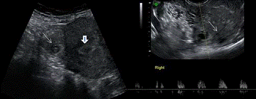 Interstitial Ectopic Pregnancy, Diagnosis and Management: A Case Report ...