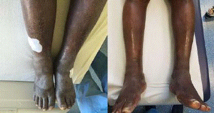 A Case of New Manifestation of Leprosy Six Months after Immigration to ...