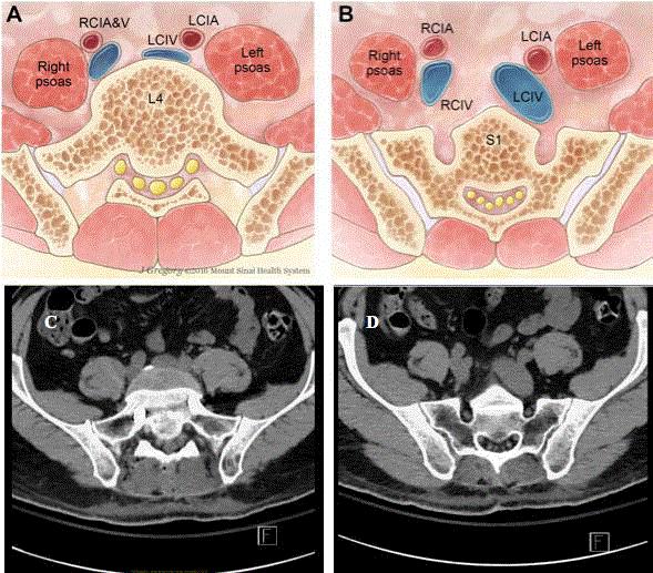 The Pancake Sign: A Case Report