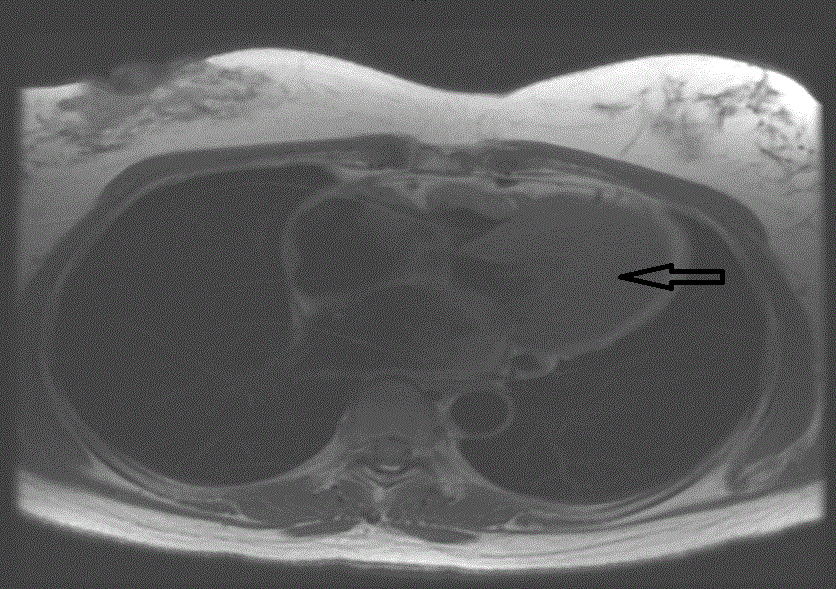 Yamaguchi’s Disease in African American Patient: A Case Report and ...