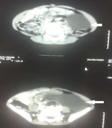 Giant Chylolymphatic Mesenteric Cysts in Children: A Preoperative Enigma