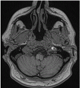 Collet Sicard Syndrome