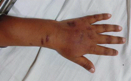 Cutaneous Aspergillosis in a Child with Acute Lymphoblastic Leukaemia
