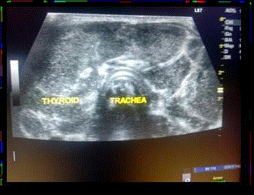 Thyroid Abscess a Rare Clinical Entity: 2 Cases with Different Clinical ...