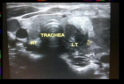 Thyroid Abscess a Rare Clinical Entity: 2 Cases with Different Clinical ...