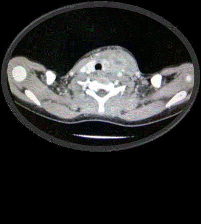 Thyroid Abscess a Rare Clinical Entity: 2 Cases with Different Clinical ...