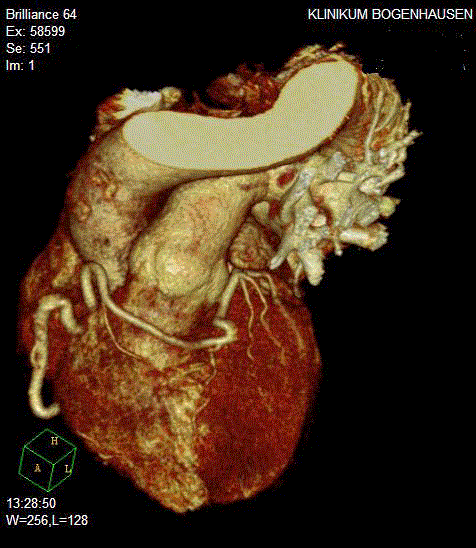 Angina Associated with Dynamic Right Ventricular Compression of ...