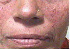 Koenen Tumors 20 Nail Involvement: A Rare Case Report