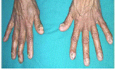 Koenen Tumors 20 Nail Involvement: A Rare Case Report