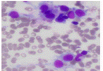 A Case Report of Hairy Cell Leukemia: An Unusual Presentation