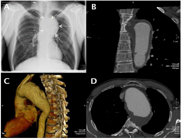 Surgical Treatment for Chronic-Contained Rupture of Thoracic Aortic ...