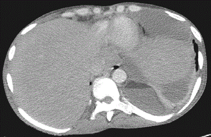Intrapleural Fat-Fluid Level: A Unique Sign in Chest Imaging