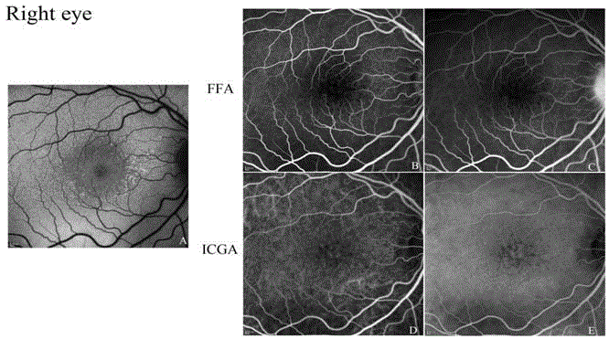 Bilateral Idiopathic Central Serous Chorioretinopathy in a Twelve Year ...