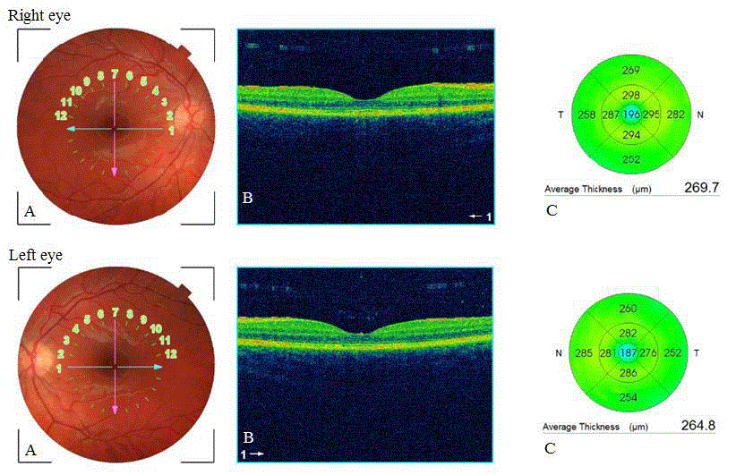 Bilateral Idiopathic Central Serous Chorioretinopathy in a Twelve Year ...