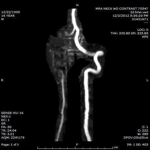 Diagnosis of Spontaneous Vertebral Artery Dissection in a Healthy Teenager