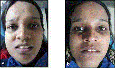 Unilateral Condylar Hyperplasia: A Case Report