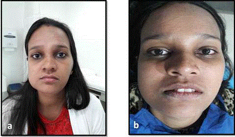Unilateral Condylar Hyperplasia: A Case Report